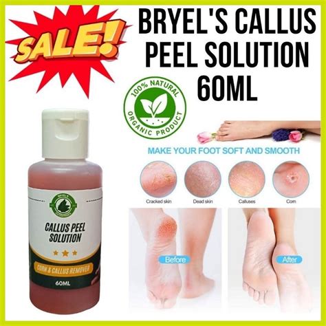 Callus Set Remover Callus Peel Remover Pantanggal Kalyo Callus Peel