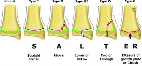 Salter Harris Classification Of Physeal Fractures The Growth Plate Is
