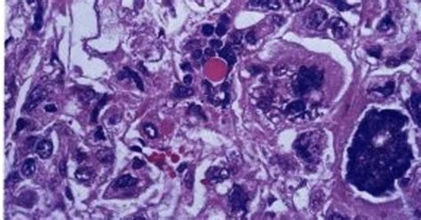 Endodermal Sinus Tumor Est Assignment Point