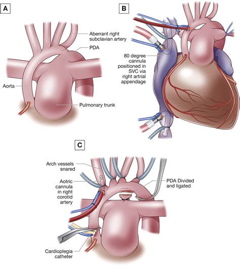 Norwood Sano Procedure With Neo Aortic Valve Repair On The Beating