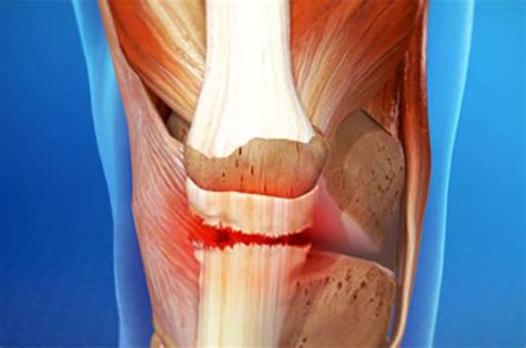 Patellar Tendon Pain Tear Or Injury Midwest Orthopaedics