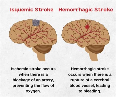 Ischemic Stroke Vs Hemorrhagic Stroke Stay Tuned For More Information