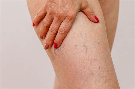 Burst Veins Causes Risks And Treatment Options Metro Vein Centers