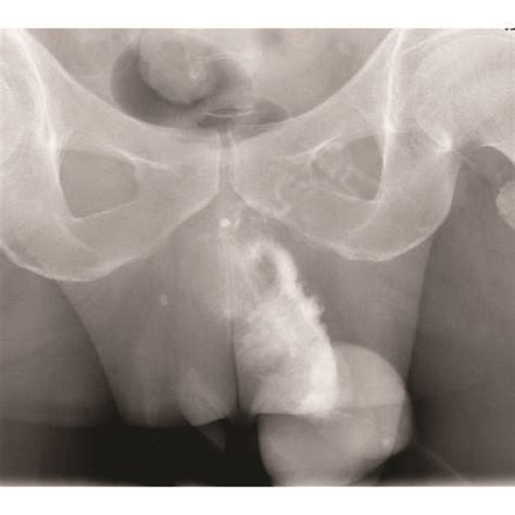 Retrograde Urethrogram Showed Significant Extravasation Of Contrast Download Scientific Diagram