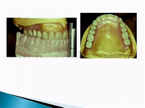 Immediate Denture Pptx