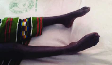 Right Lower Limb In Extension Position During Spasm Download Scientific Diagram