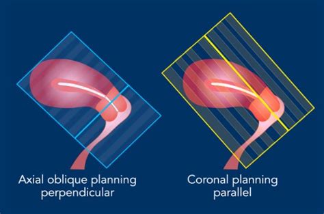 Cervix Cancer Staging