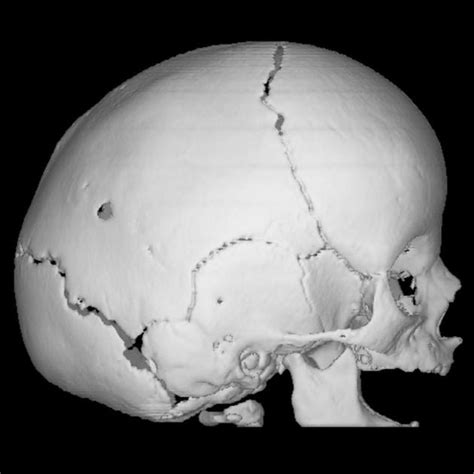 Dolichocephaly Pacs