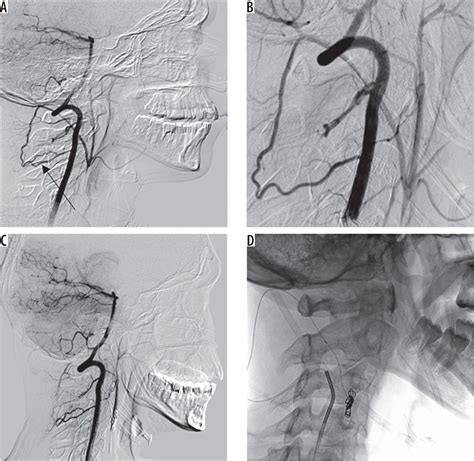 Bilateral Thalamic Stroke After Tonsillectomy In Patient With
