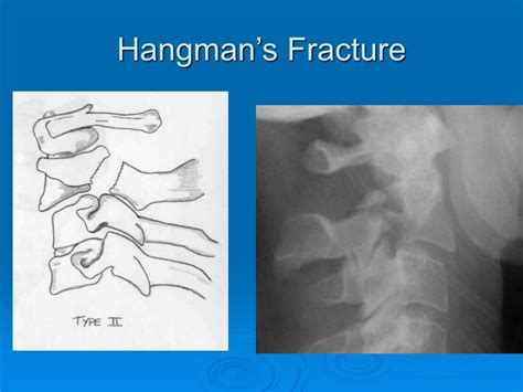 Ppt Cns Pathology Powerpoint Presentation Id 528134