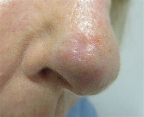 Basal Cell Carcinoma Pictures Visual Bcc Examples By Mr Tehrani