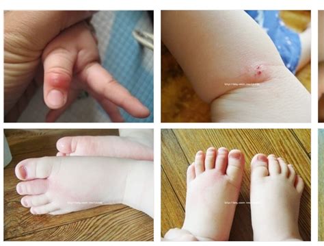 개미 키우기 및 물린자국 사진 네이버 블로그