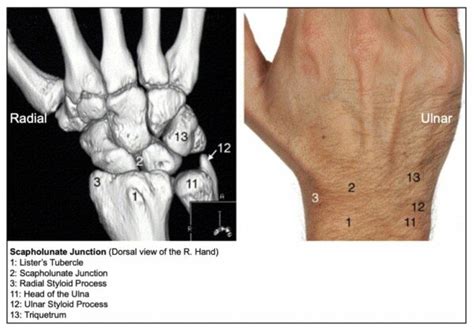 Carpal Bone Injuries The Big 4 Emergency Medicine Cases