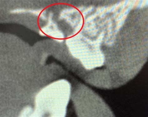 Persistent Deciduous Teeth Unerupted Permanent Teeth Dentigerous Cyst