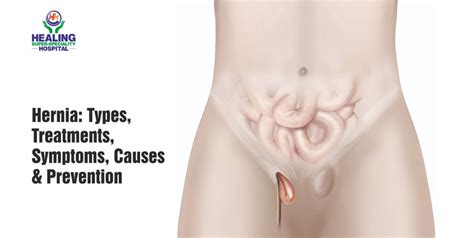 Hernia Types Treatments Symptoms Causes And Prevention