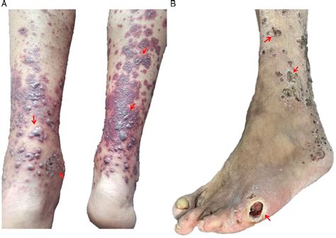 Figure 1 From Vasculitis And Infectious Risk In A Patient With Type 2