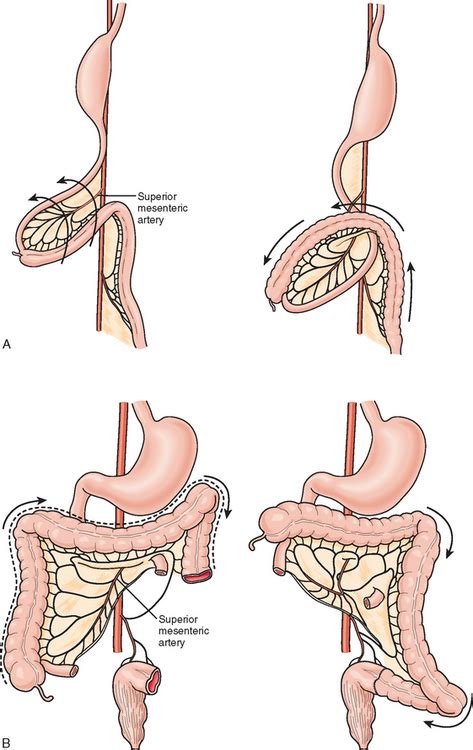 General Laparotomy Basicmedical Key