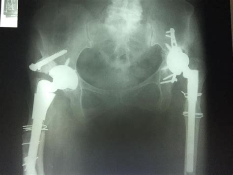 69 Years Old Female 13 Years Of Tha For High Hip Dislocation Now 26o