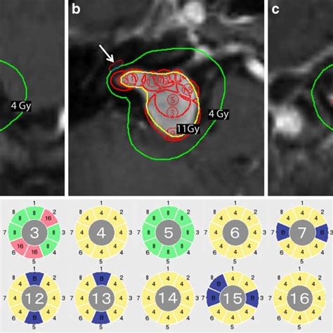 A D Left Leksell Gamma Knife Perfexion Radiation Unit And Collimator