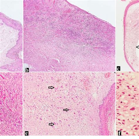 A Polypoidal Mass Lined By Stratified Squamous Epithelium On All Sides
