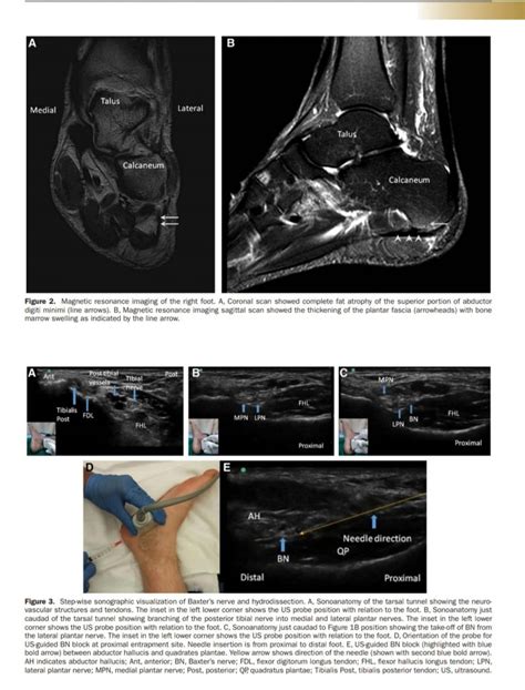 Anesthesia And Analgesia Practice Ultrasound Guided Hydro Dissection Of Baxters Nerve With