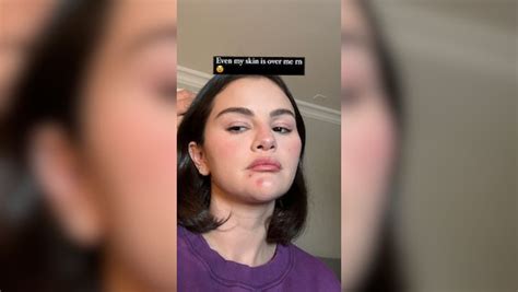 Selena Gomez Le Acne Did Selena Gomez Get Botox Bizrahmed