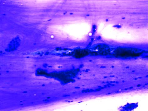 Cytology Of Mucinous Borderline Tumor Showing Honeycomb Tumor Sheets In