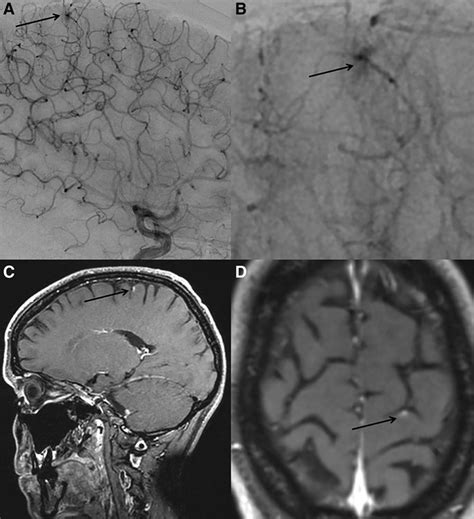 Hereditary Hemorrhagic Telangiectasia Brain Patient Information