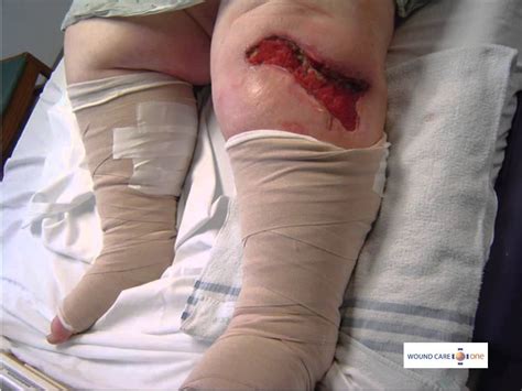 Granulation Tissue Plastic Surgery In Springfield Mo Reynolds