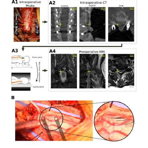 Validation Of Stimulation Location Relative To Dorsal Root Entry Zones