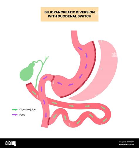 Biliopancreatic Diversion Bpd With Duodenal Switch Illustration