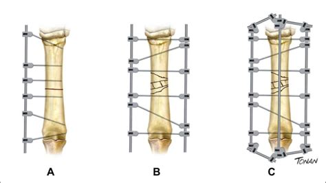 External Fixation Types
