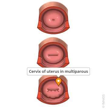 Cervix Of Uterus In Multiparous E Anatomy Imaios