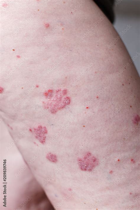 Allergic Rash Dermatitis Eczema Skin On Leg Of Patient Psoriasis And