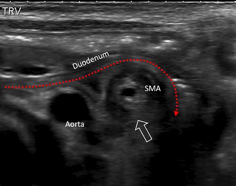 Imaging Features Of Neonatal Bowel Obstructionradiographics