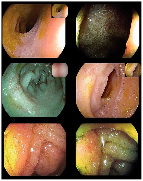 Terminal Ileum Colonoscopy Normal