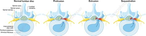 Herniated Disc Progression Illustration Stock Image F0431360