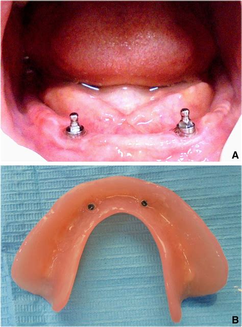 One Time Definitive Attachment Connection Versus Healing Abutment