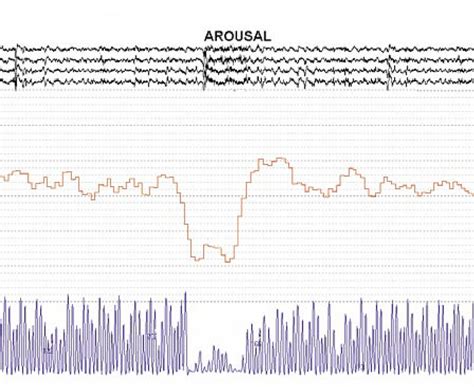 —an Example Of An Electroencephalogram Eeg Arousal With Associated