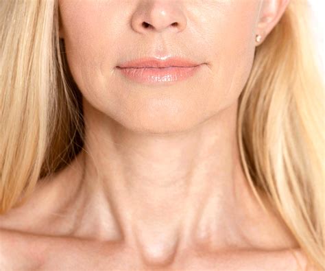 Botox Neck Bands Kopelson Clinic