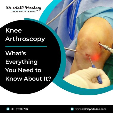 Knee Arthroscopy Whats Everything You Need To Know About It