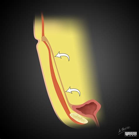 Urachus Urachus Radiology Reference Article