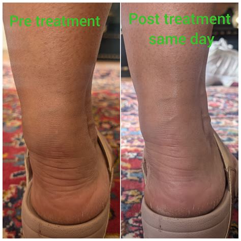 Et Amazing In Session Progress For A Pesky Ankle Bursa 🤓