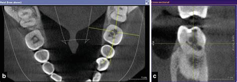 Root Resorption Pocket Dentistry