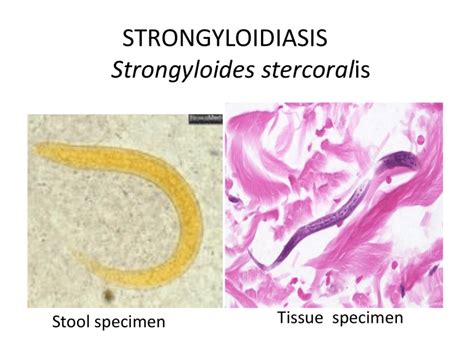Strongyloidiasis Symptoms Diagnosis And Prevention