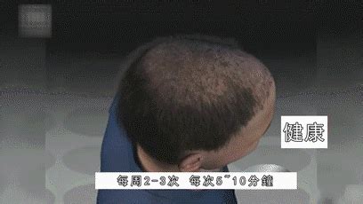 Gzbityhn生髮精華液官網 養髮防脫神器解決脫髮、禿頭，生髮水