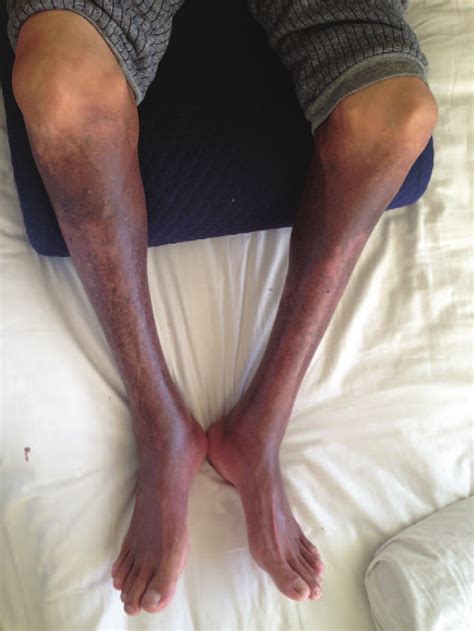 Photographs Of Patient Showing Hyperpigmented Skin Of Lower Limbs