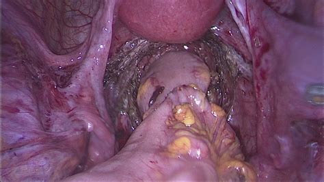 Robotic Surgery Of Endometriosis Rectal Disc Excision And Sigmoid