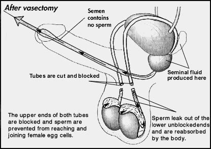 Where Does Sperm Go After A Vasectomy