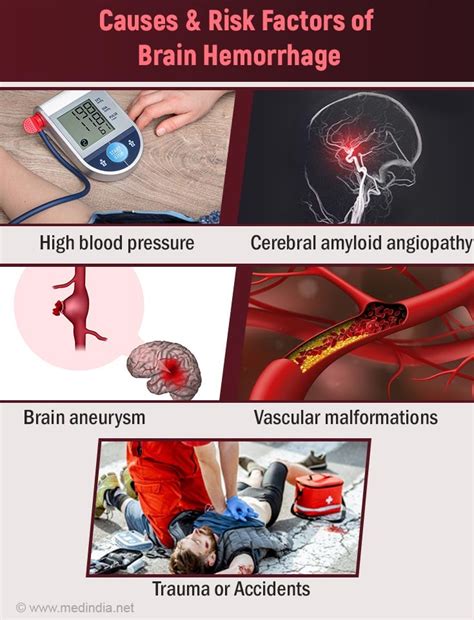 Brain Hemorrhage Intracranial Hemorrhage Causes Symptoms